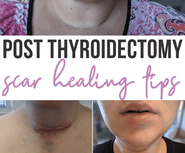 Thyroidectomy Scar Healing Tips - Sadie Smiley